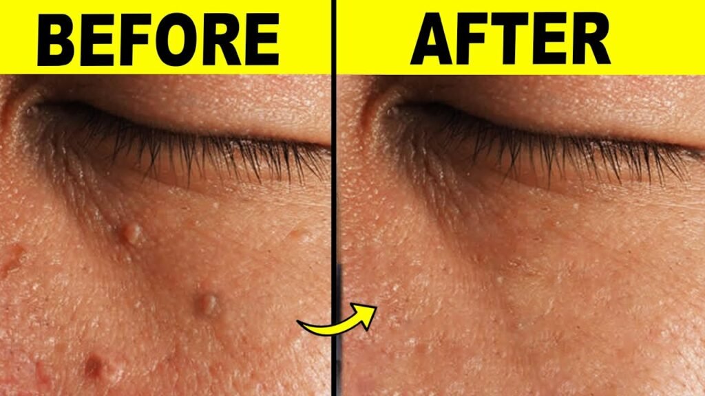 Say Goodbye to Skin Tags: 9 Home Remedies That Actually Work - Jokes Daddy